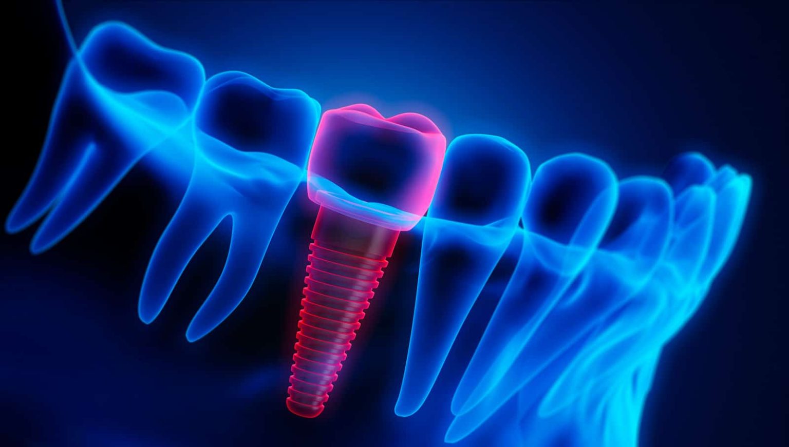 Benefits of Dental Implants | North Boulder Dental